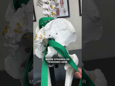Sciatica's SECRET ROOT PROBLEM!