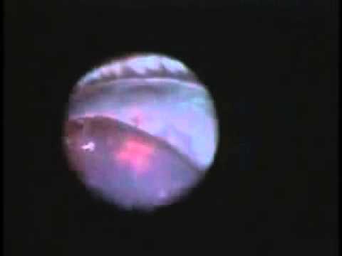 Michael Orr, MD ECP surgery video