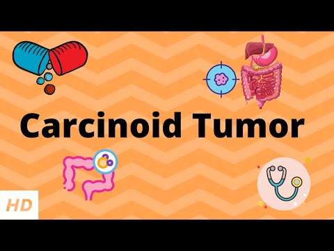 Carcinoid Tumor, Causes, Signs and Symptoms, Diagnosis and Treatment.