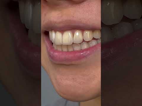 4 Veneers for this dentist patient. #readdescription #veneers #dental