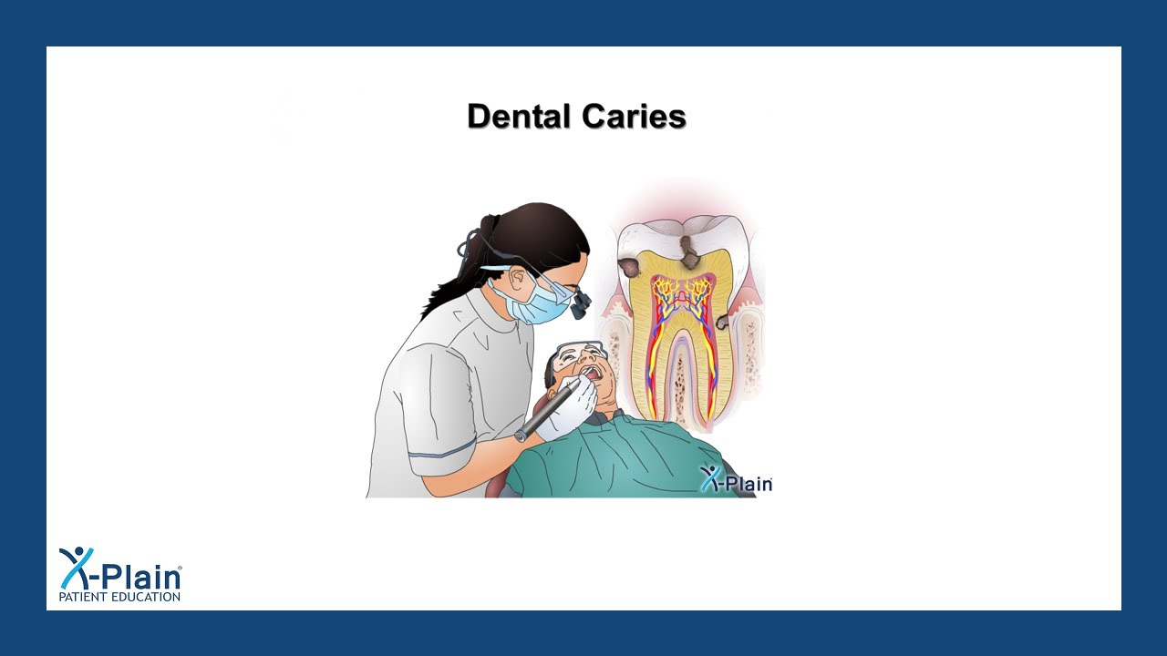 Dental Caries (Patient Education)