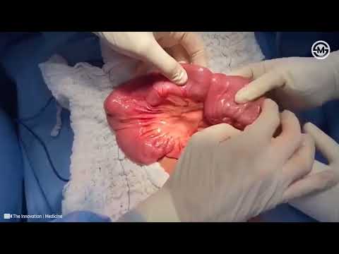 This is what it looks like when Intussusception happens.