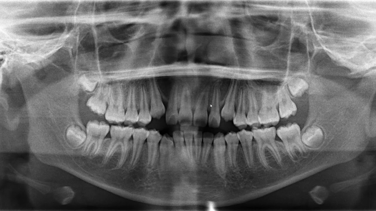 Interpretation series: panoramic radiograph - normal or abnormal?