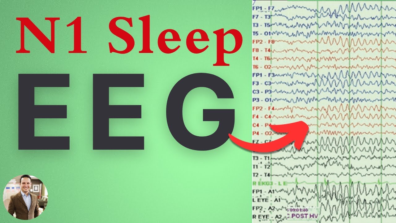 N1 Brainwaves in Sleep on EEG Explained: Vertex Waves, POSTs