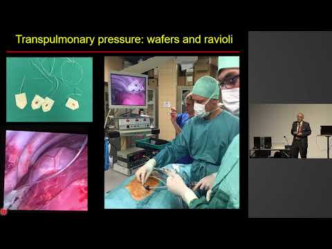 The new PEEP step method for transpulmonary pressure - too good to be true? Paolo Pelosi - SSAI2017
