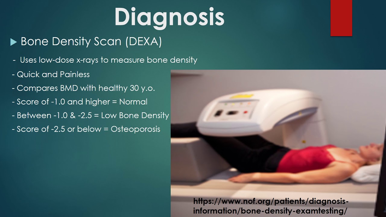 Temple Osteoporosis PPT