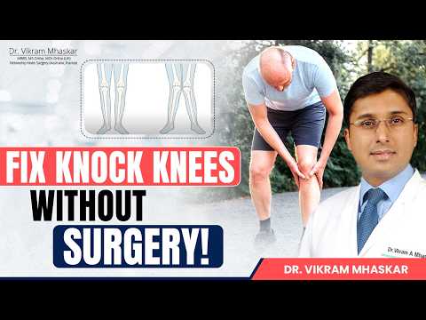 Knock Knees को Correct करने के आसान तरीके ! How to Correct Knock Knees | Dr.Vikram Mhaskar