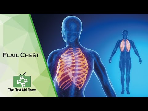 Flail Chest