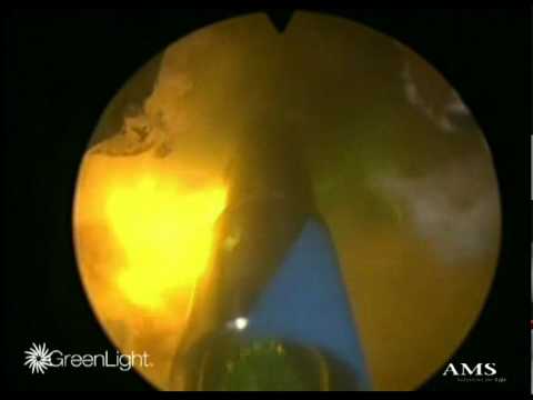 GreenLight Laser MoXy - The Prostate Clinic