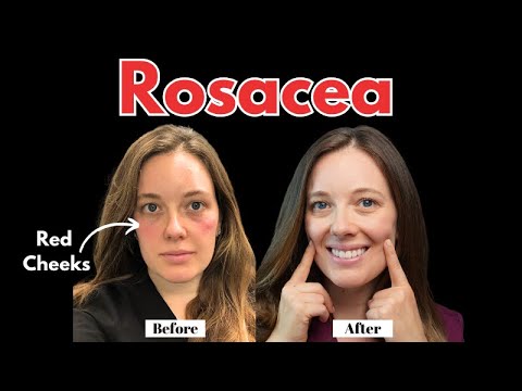 Best Ways to Treat Rosacea