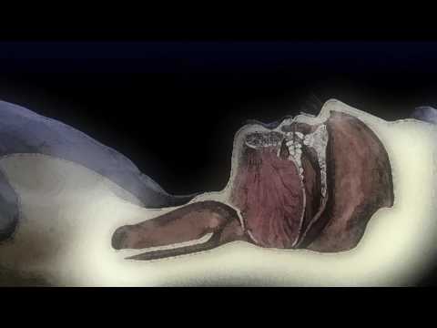 ResMed - What is obstructive sleep apnea ?