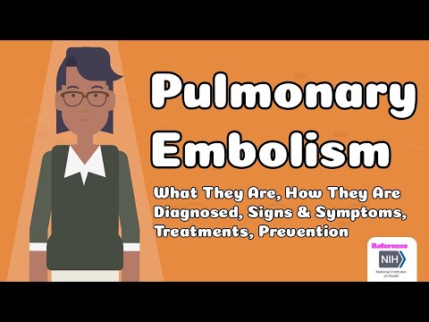 Pulmonary Embolism - What They Are, How They Are Diagnosed, Signs & Symptoms, Treatments, Prevention