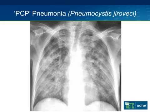 Opportunistic Infections I