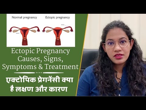 Ectopic Pregnancy Causes, Signs, Symptoms & Treatment एक्टोपिक प्रेगनेंसी क्या है लक्षण और कारण