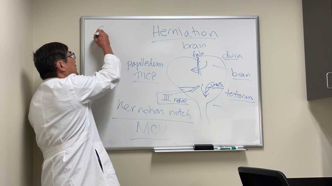 Brain herniation syndromes