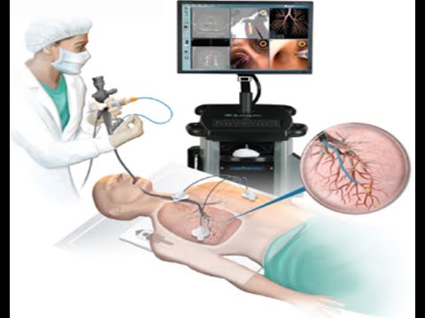Bronchoscopy with balloon dilation CPT code - simplify medical coding