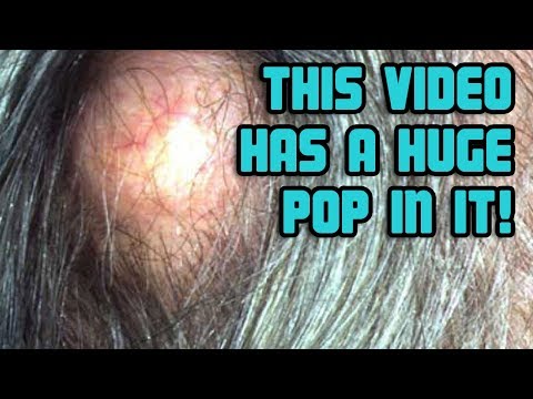 World's Largest Scalp Zit! Educational Discussion!