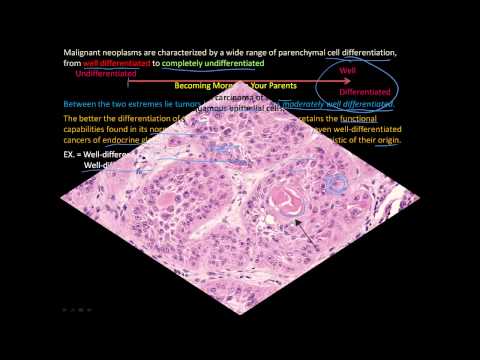113P How to tell a benign and malignant tumor apart? Differentiation and Anaplasia