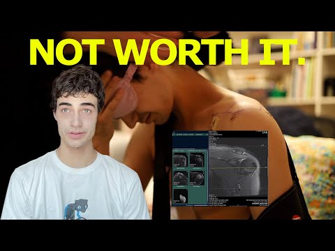 Why I Regret My Shoulder Surgery (Labrum Repair)