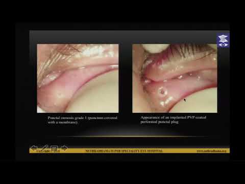 AIOC2018 - FP1661 - Lacrimal - Topic - "Efficacy of Perforated Punctal  ....."