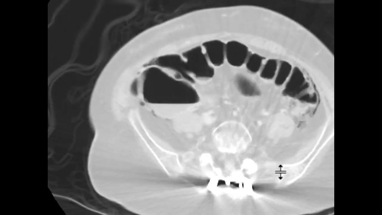 Benign Pneumatosis