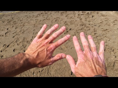 What is Vitiligo: Explanation and Examples