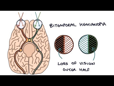 [VIDEO] Understanding Bitemporal Hemianopia – YouTube | TBI Rehabilitation