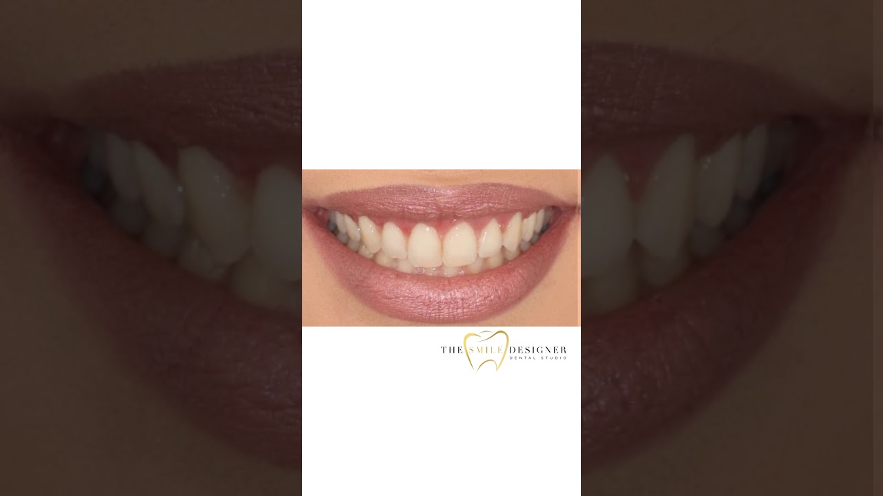 Gummy Smile Treatments at your Melbourne Dentist