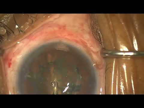 Cataract surgery using Femtosecond Laser, iStent, and Multifocal IOL