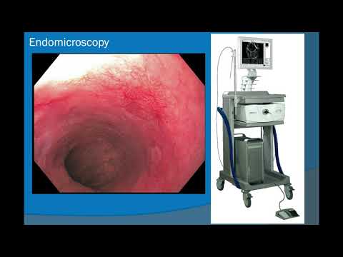 Barrett's Esophagus - Detection and Treatment - Dr. Ken Chang (University of California, Irvine)