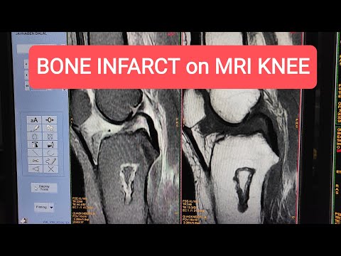 Bone Infarct on MRI Knee 1.5 Tesla GE.