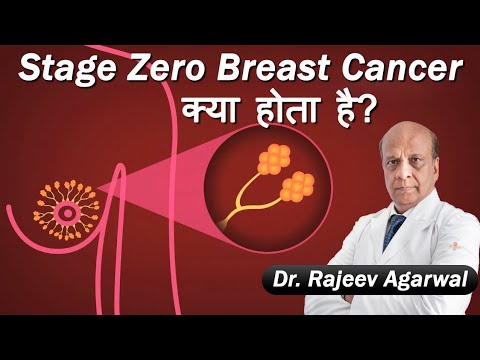 Stage 0 (Zero) Breast Cancer or Ductal Ca In Situ (DCIS) क्या होता है? | Dr. Rajeev Agarwal