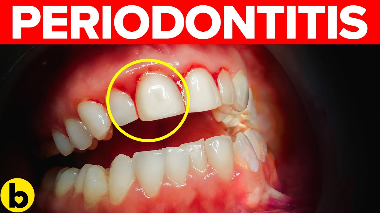 Periodontitis: Stages, Symptoms, Causes & Treatment
