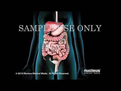 Laparoscopic Lysis of Abdominal Adhesions