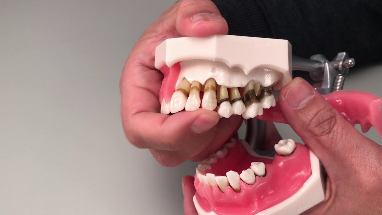 PERIO MODEL w/ TOOTH MOBILITY 1