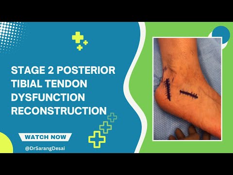 Stage II PTTD Reconstruction