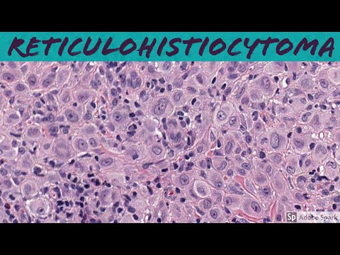 Reticulohistiocytoma: 5-Minute Pathology Pearls