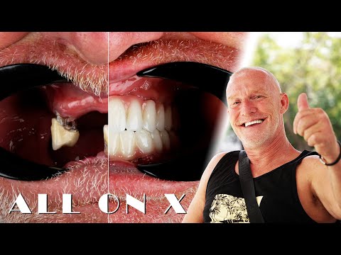 All On " X "  (Full Mouth Implant Restoration) / Testimonial