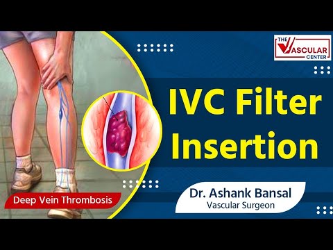 IVC Filter Insertion: Advanced Treatment for Deep Vein Thrombosis Explained | Dr. Ashank Bansal