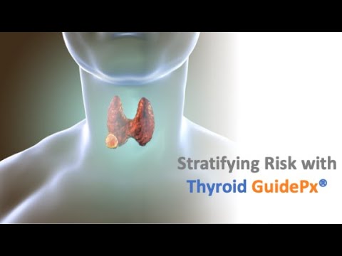 Stratifying Risk with Thyroid GuidePx