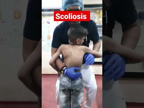 scoliosis treatment #drrajneeshkant