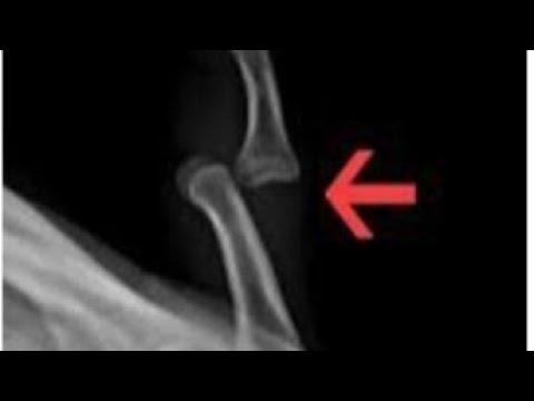 Anatomy of joints with reference to dislocation and injury (clinical)