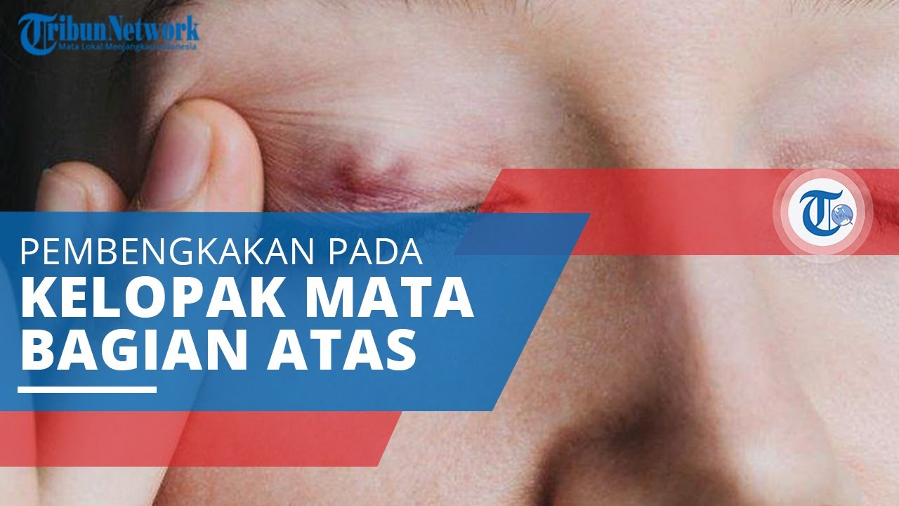 Kalazion, Pembengkakan atau Benjolan yang Sebagian Besar Terdapat pada ...
