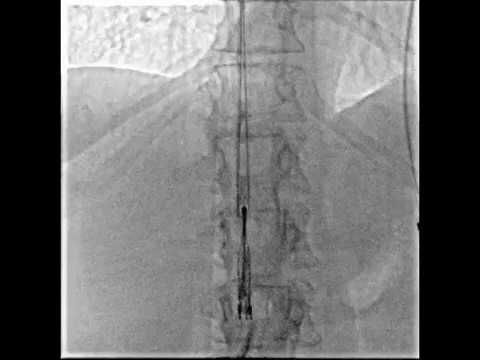 Loop snare technique of IVC filter removal