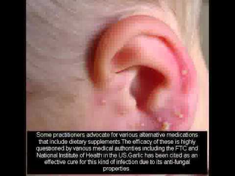 male yeast infection symptoms pictures