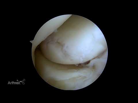 BioCartilage® Extracellular Matrix Mixing and Delivery Advancements in the Elbow