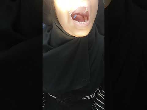 Part (1) Root Canal Opn And infected Toothwarm please Channel ko Subseribe kre...