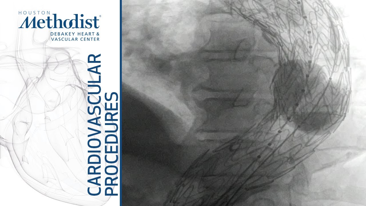 A Comprehensive Guide to TEVAR for Descending Thoracic Aneurysm | Galaxy.ai