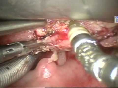 Ray Blanco, MD FACS - Transoral Robotic Surgery - Head and Neck Surgery at GBMC