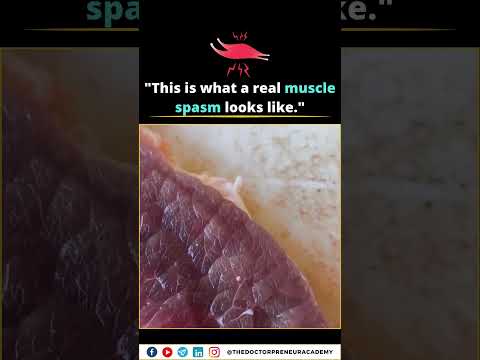 What Is a Muscle Spasm? Causes, Symptoms & Quick Relief 💥🩺